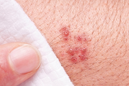 Shingles: The real meaning of pain | Las Vegas Review-Journal