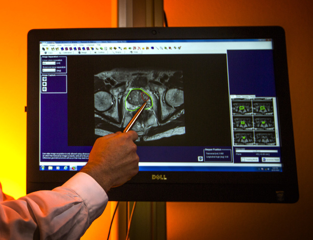 New prostate biopsy procedure aids diagnosis | Health | Life