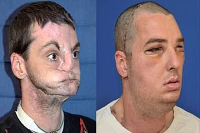 Face transplant recipient meets sister of donor | Life