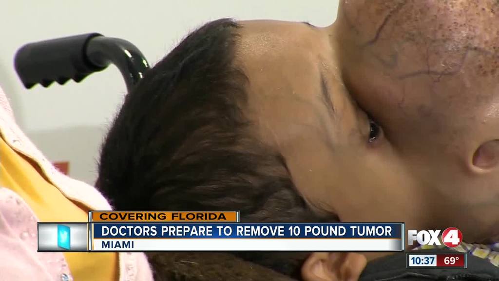 Doctors to remove 10-pound facial tumor that started as pimple ...