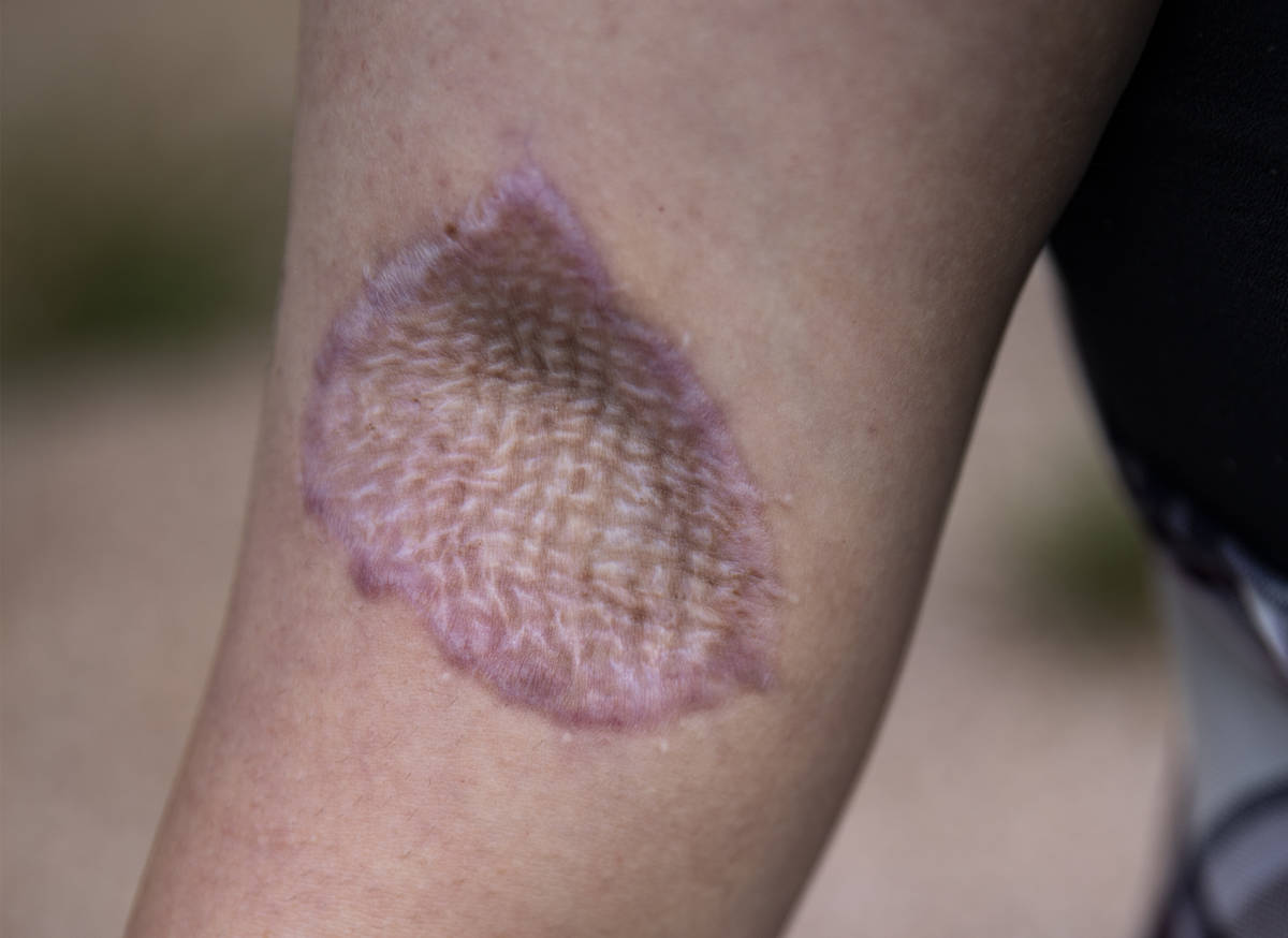 What Causes Flesh Eating Bacteria
