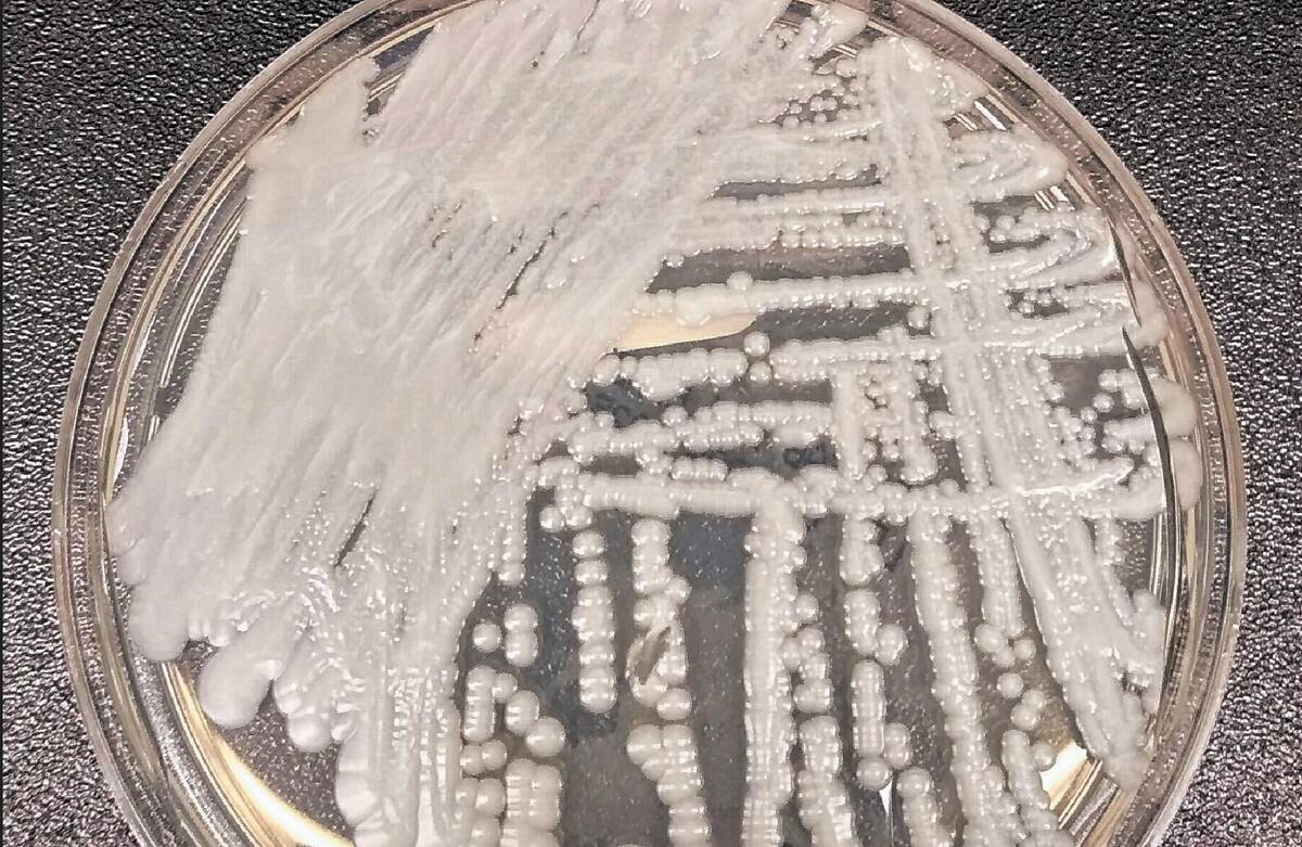 Southern Nevada Candida auris cases hit record high | Health | Life